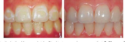 Enamel Decalcification