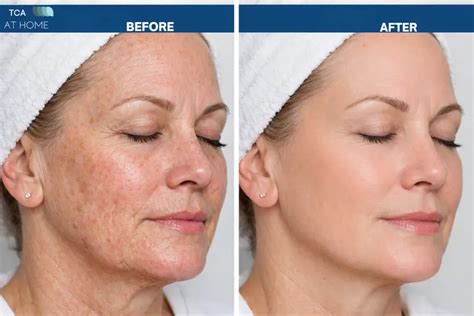 Tca Peel Before And After What To Expect 2026 Update