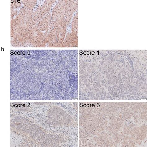 Immunohistochemical Staining Of P16 Specimens With A Nuclear