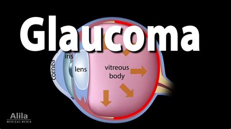 Closed Angle Glaucoma Vs Open Angle