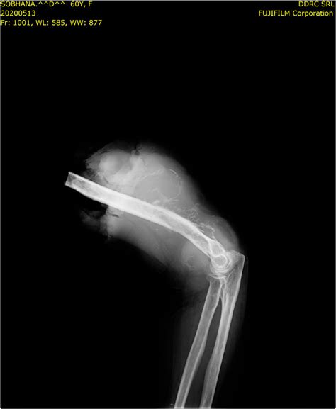 X Ray Of Amputated Specimen Showing Tumour Calcification And Download Scientific Diagram