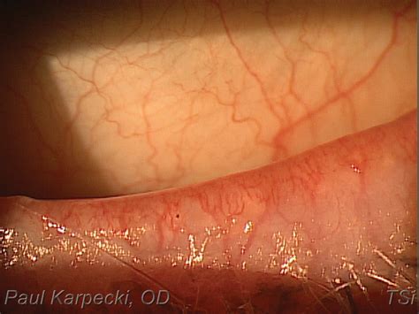 Telangiectasia Eyelid