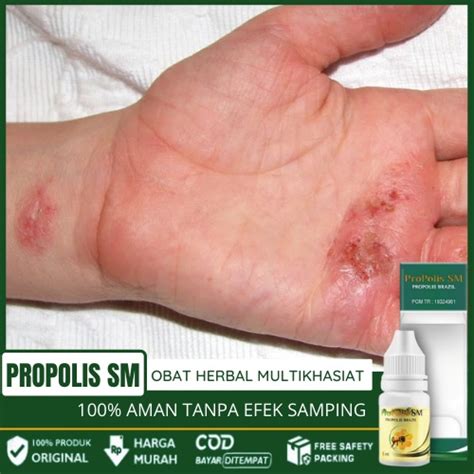 Jual Obat Bintik Bening Berair Gatal Di Jari Tangan Obat Alami Jari Tangan Gatal Obat Gatal