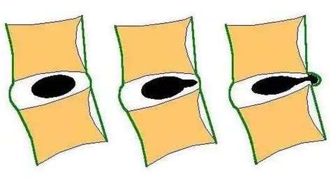 Chondrosis Of The Lumbar Spine Symptoms Treatment Causes And