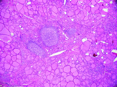 Thyroid Gland Total Thyroidectomy Showed Chronic Lymphocytic Download Scientific Diagram