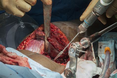 Tibial Plateau Fracture Posterior Column Fracture Fixed With Synthes Proximal Tibial Liss Plate