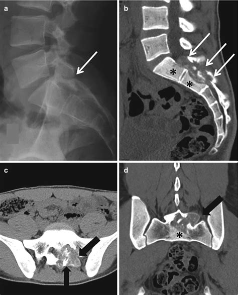 Imaging Of Sacral Tumors And Tumor Simulators Experience Of The Mayo Clinic Radiology Key