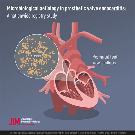 Microbiological Etiology In Prosthetic Valve Endocarditis A Nationwide