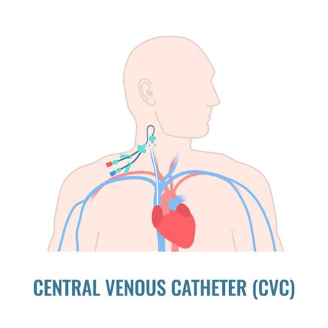 Streamlining Care Navigating The Essentials Of Picc Line Placement