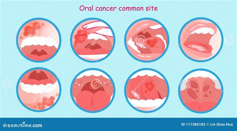 Mucositis Cartoons Illustrations And Vector Stock Images 30 Pictures