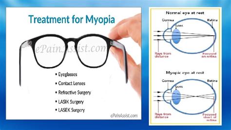 Pathological Myopia Pathological Myopia Clinical Refractive Error 6