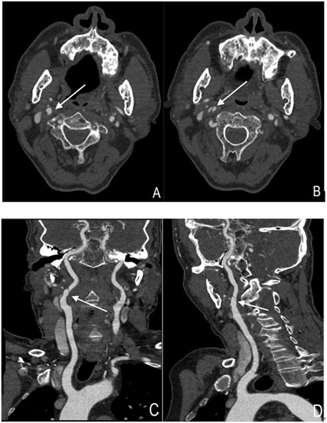 Frontiers Carotid Artery Dissection Recanalization Imaging