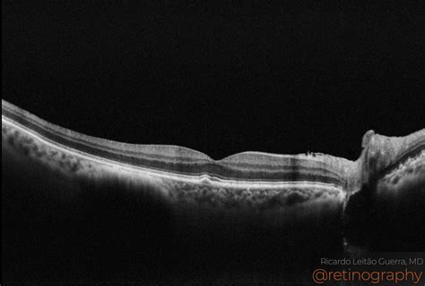 Choroidal Nevus Retinography