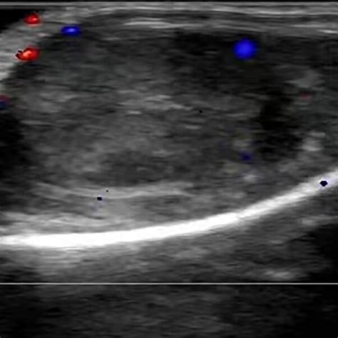 Ultrasound Image Of The Right Testis On Hospital Admission The Color