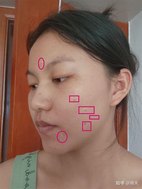 激光点痣恢复记录 知乎