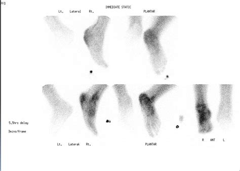 Osteomyelitis Bone Scan