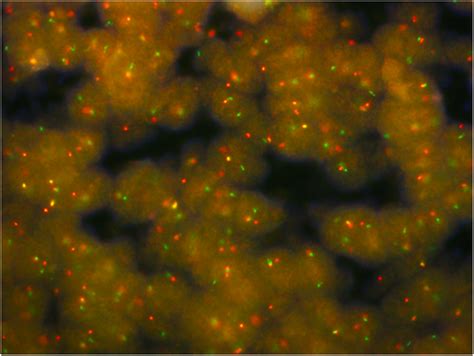 Dual Color Break Apart Specific Locus Fish Probe Targeting Ewsr1 Gene