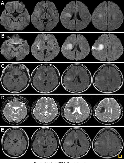 Figure 1 From Herpes Simplex Encephalitis Presenting As A Stroke Like