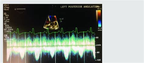 Echocardiogram Showing Pulsus Alternans Download Scientific Diagram