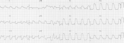 Pin On Ekg