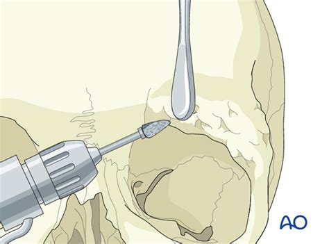 Partial Ostectomy And Contouring For Extensive Fibrous Dysplasia Partial Ostectomy And Contouring For Extensive Fibrous Dysplasia