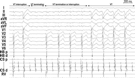 Reply Verapamil Sensitive Idiopathic Left Ventricular Tachycardia