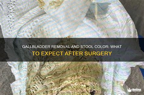 Gallbladder Removal And Stool Color What To Expect After Surgery Medshun