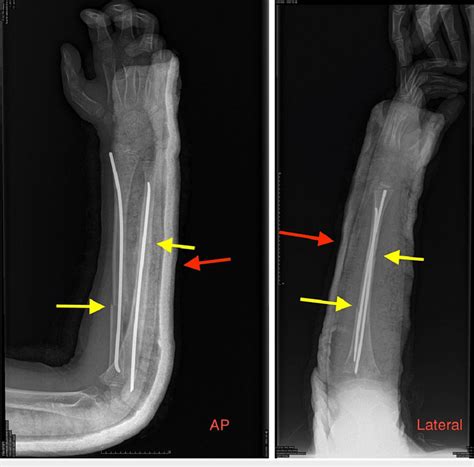 Postoperative Anterior Posterior And Lateral Radiographs Of The Left