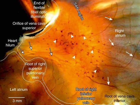 Innervation Of The Sinoatrial Node Clinical Tree