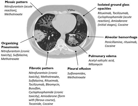 Hrct Patterns Of Drug Induced Interstitial Lung Diseases A Review