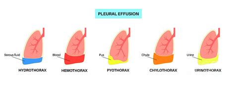 Pleural Effusion 14 By Pikovit Science Photo Library