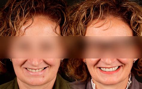 Bone Regeneration In Fuengirola Clínica Dental Viéitez Núñez