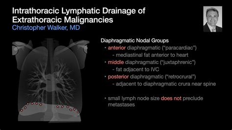 Society Of Thoracic Radiology On Twitter Dr Christopher Walker Discusses · Imaging Clues For