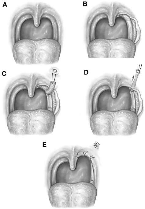 Sleep Apnea Treatment Sleep Apnea Surgery Indigo Ent