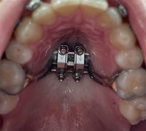 Pallet Expander That Is Screwed Into The Bones Sucks R Braces