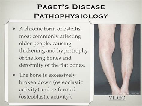 Icd 10 Possible Pagets Disease At Todd Reno Blog