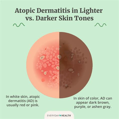 What Is Atopic Dermatitis Symptoms Causes Diagnosis Treatment And