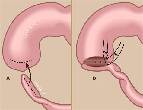 Duodenal Atresia Causes Symptoms Diagnosis Treatment And Prognosis