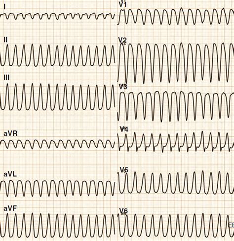 Rvot Ventricular Tachycardia Ecg Book