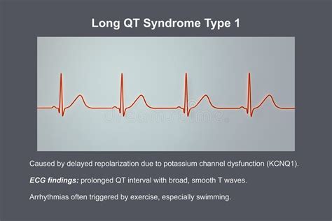 Ecg In Long Qt Syndrome Type 1 3d Illustration Annotated Stock