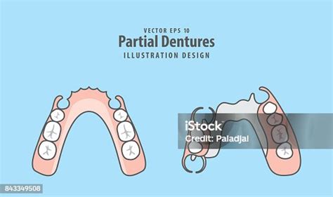 Removable Partial Denture Design