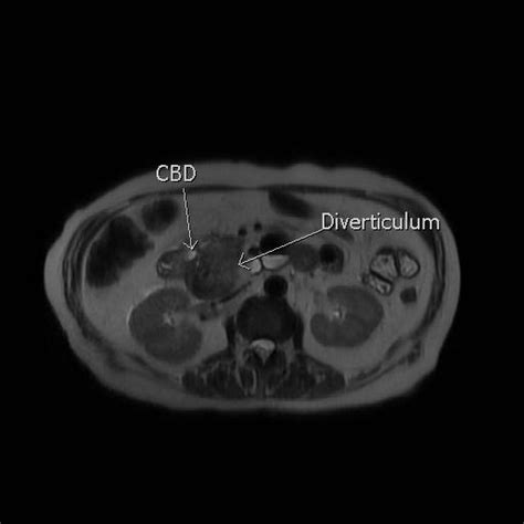 Biliary Obstruction From Juxtapapillary Duodenal Diverticulitis Eurorad