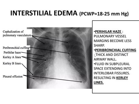 Chest X Ray Alveolar Diseasespptx