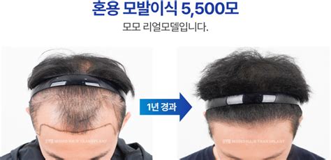 남성 비절개 모발이식 집중 모모성형외과