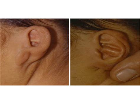 Ear Presentation Dr Robert Ruder