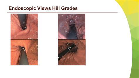 Ppt Surgical Management Of Hiatal Hernia