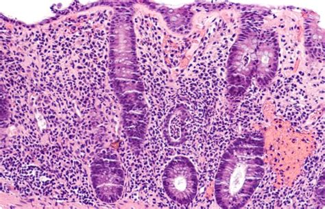 Dss Induced Colitis Model Mp Biomedicals