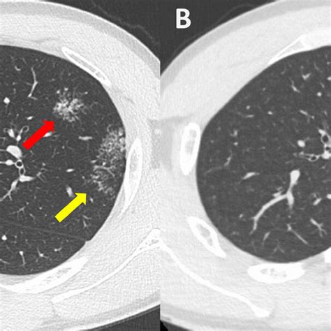 A Chest Ct Showing A Cluster Sign Yellow Arrow And Galaxy Sign Red