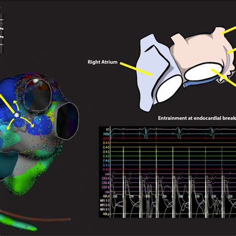 A Trial Tachycardia Presumably Utilizing Vein Of Marshall Bypass Tract