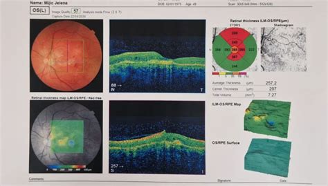 Milan Vukicevic On Linkedin Doyne Honeycomb Retinal Dystrophy 1 4